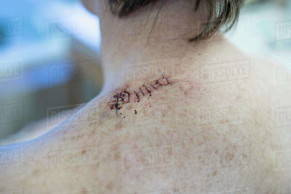 Medical stitches in woman's back after surgery - Royalty-free Stock ...