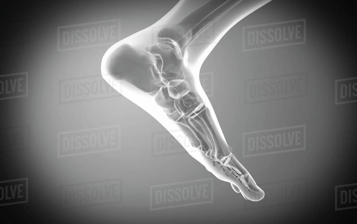 X-ray view of human foot. - Royalty-free Stock Photo | Dissolve