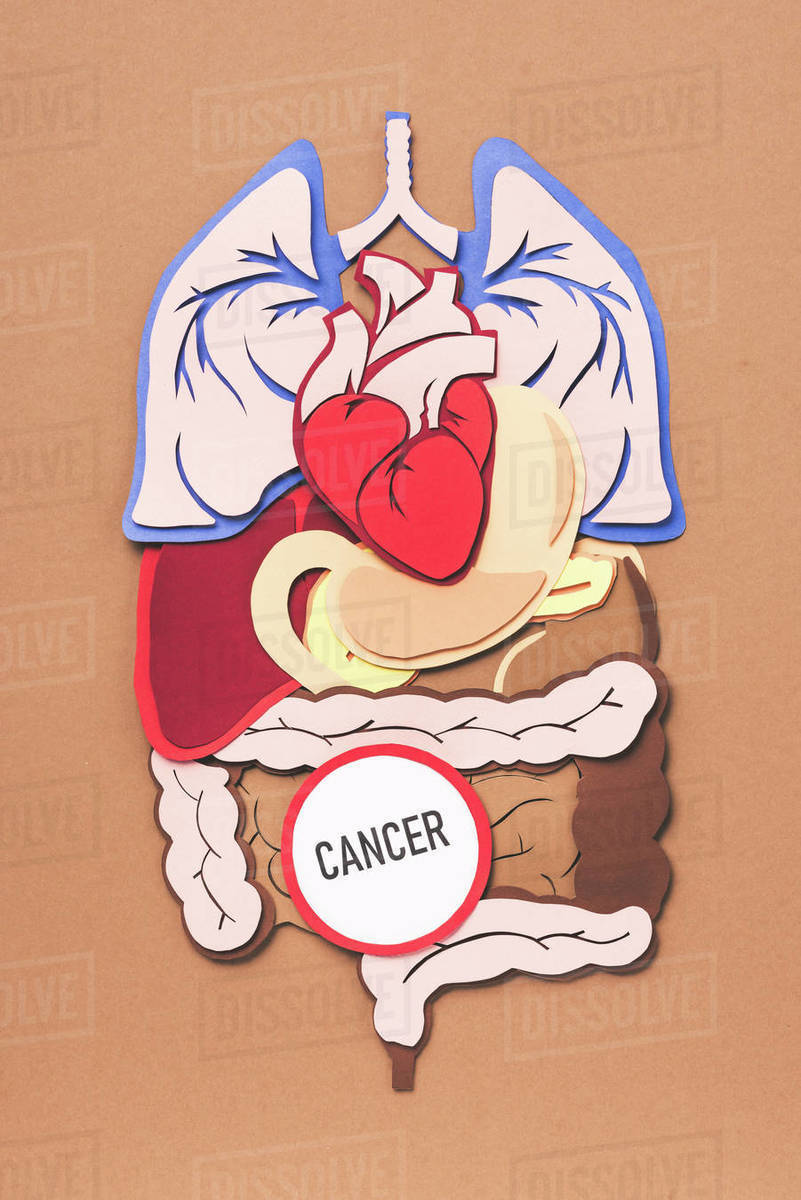 Flat lay with human internal organs and lettering cancer on brown ...