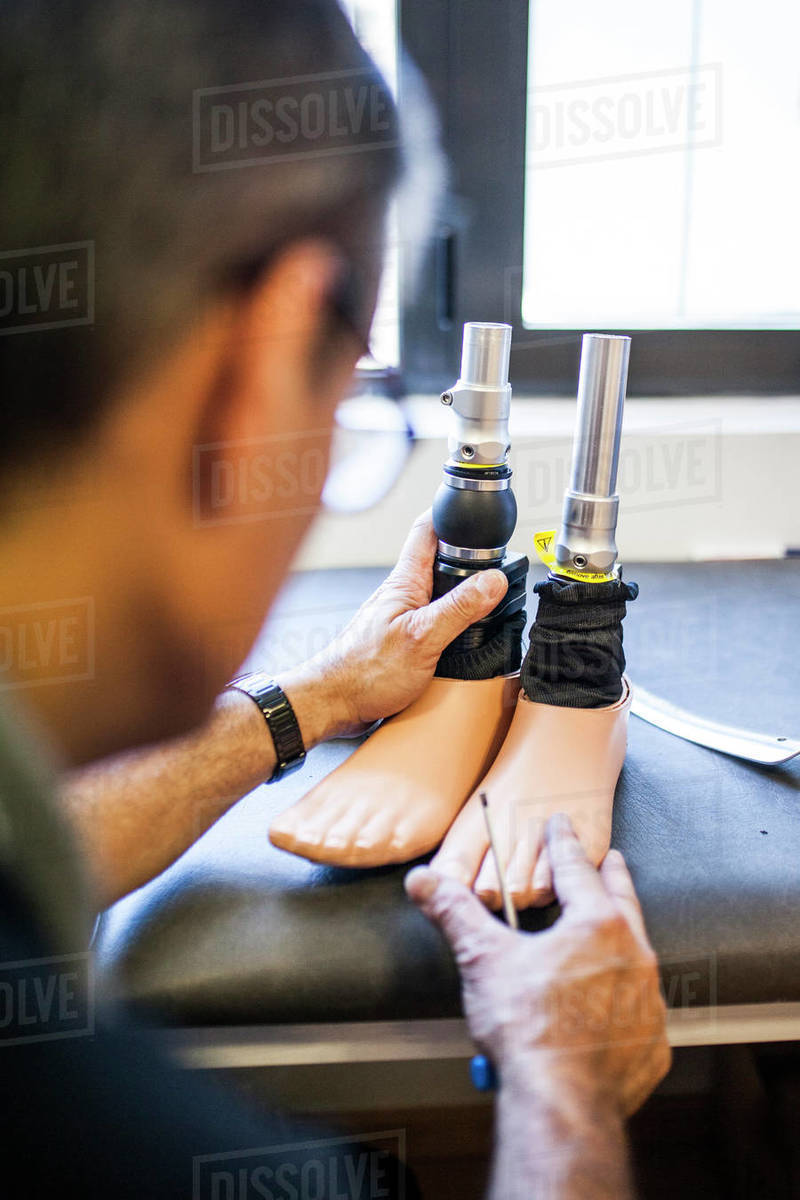 Prosthetic engineer reviewing the prosthesis of a patient and improving ...