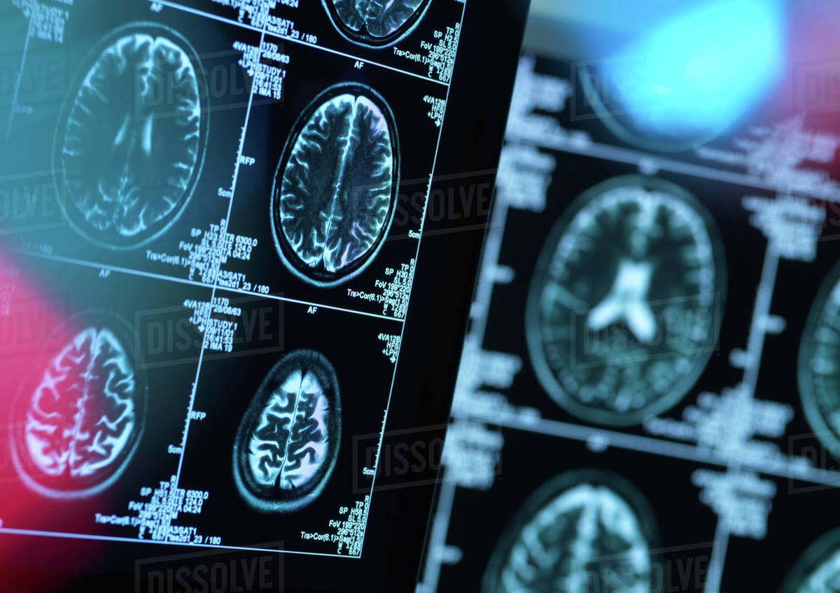 Brain scans of possible disease or damage in clinic - Stock Photo ...