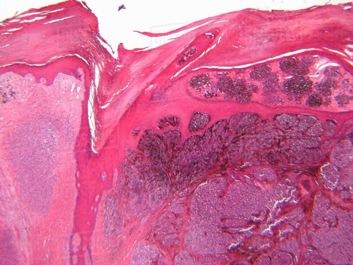 Microscope view of malignant melanoma - Stock Photo - Dissolve