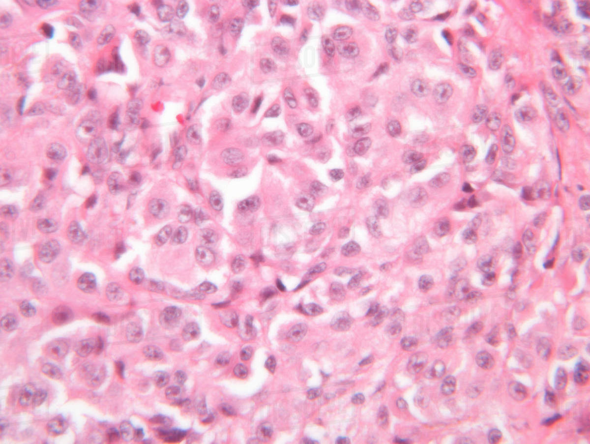 Microscope view of malignant melanoma - Royalty-free Stock Photo | Dissolve