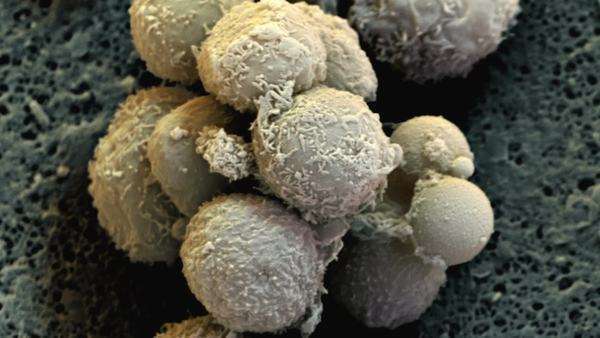 T-lymphocyte cancer cell therapy, coloured scanning electron microscopy ...