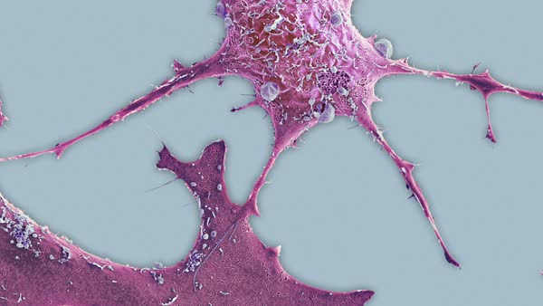 Animated coloured scanning electron micrograph (SEM) of a breast cancer ...