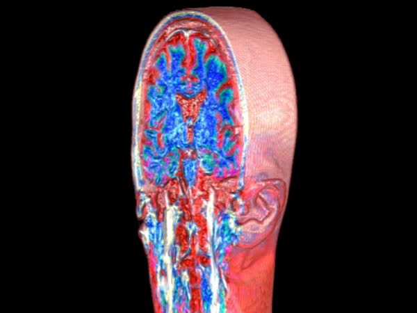 Brain and spinal cord, rotating coronal MRI scan - Stock Video Footage ...