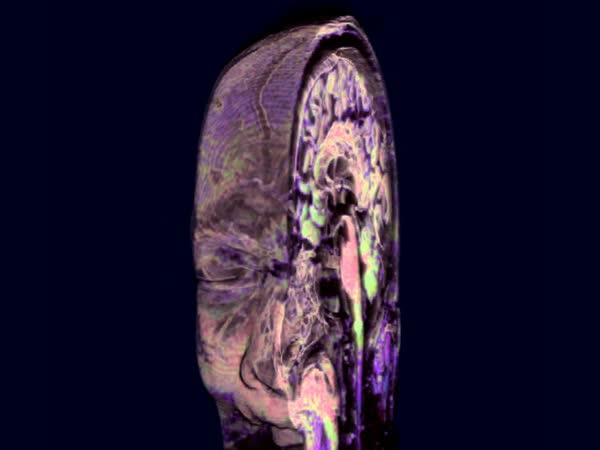 Brain and spinal cord, rotating sagittal MRI scan - Stock Video Footage ...