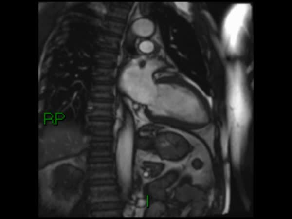 Cardiac MRI, coronal dynamic scan - Stock Video Footage - Dissolve