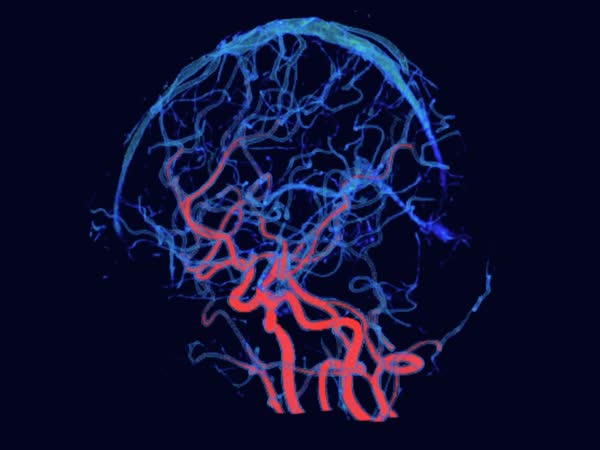 Intracranial and extracranial arteries, rotating 3D CT scan - Stock ...