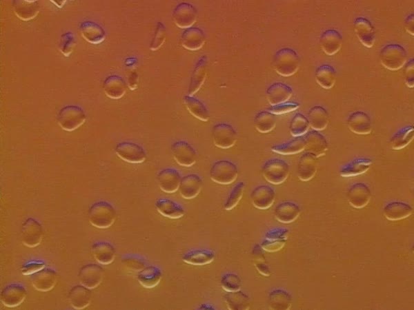 Sickle cells in blood, microscopy - SD Rights-managed Stock Video ...