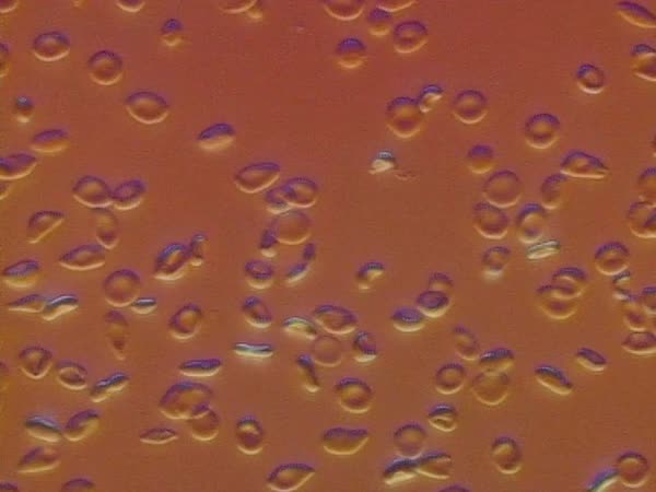 Sickle cells in flowing blood, microscopy - Stock Video Footage - Dissolve