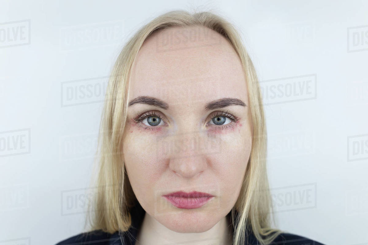 Allergy to cosmetics. The girl looks at the pimples around her eyes ...