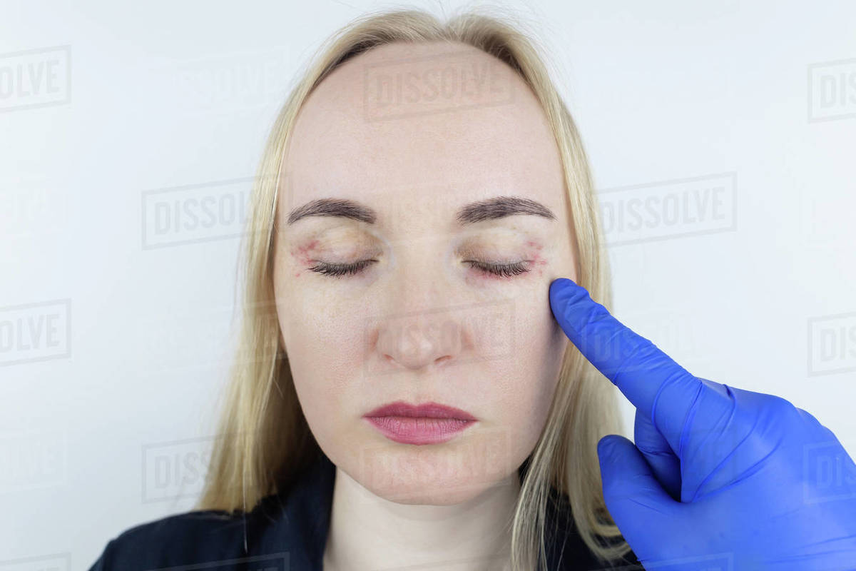 Allergy to cosmetics. The girl looks at the pimples around her eyes ...