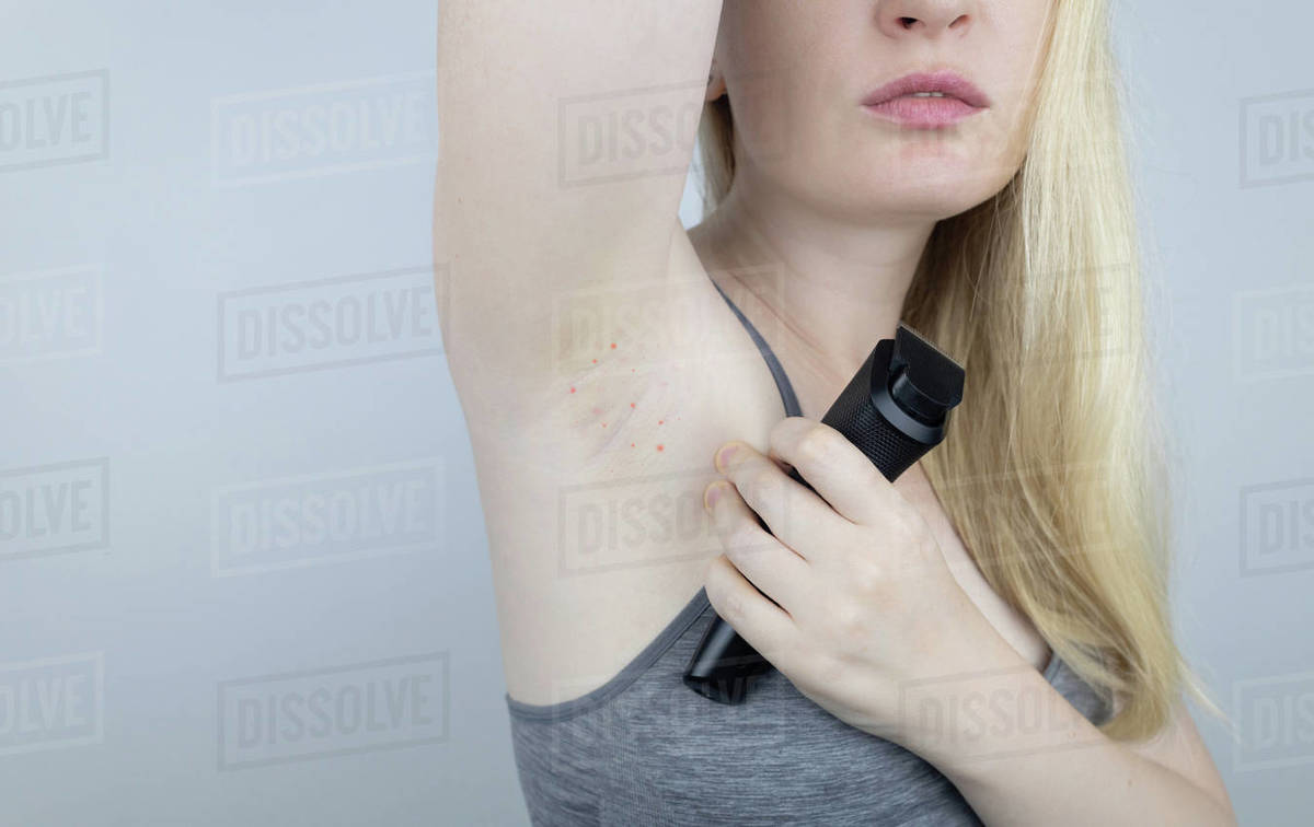 Armpit rash. Underarm skin irritation. Blonde girl shows irritation on ...