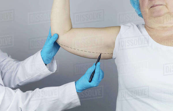 Brachioplasty. Plastic arms, dangling skin at the elbow. An older woman ...