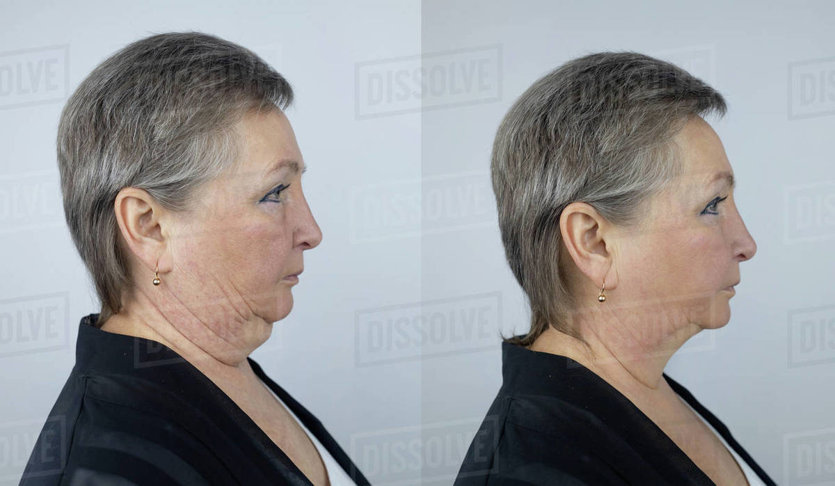 Second chin lift in senior woman. Photos before and after plastic ...