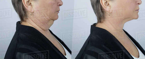 Photos before and after plastic surgery to remove Venus rings. Contour ...