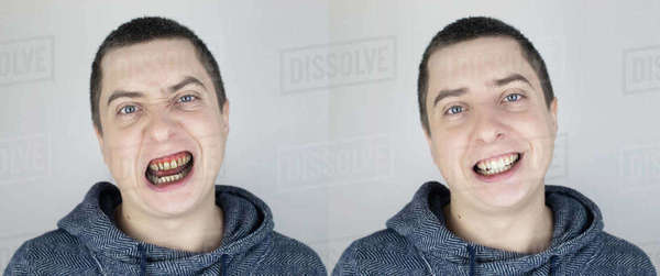 Before and after. The man shows the damaged teeth by caries, and in the ...