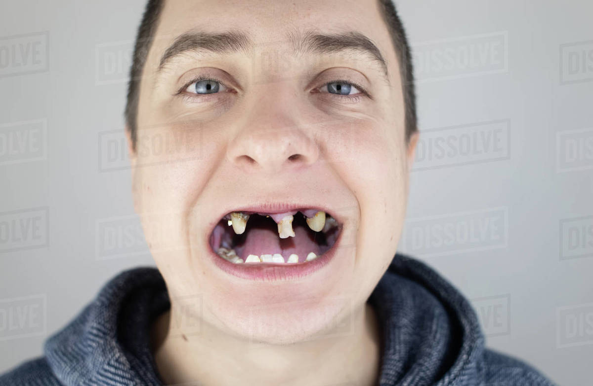 The man has rotten teeth, teeth fell out, yellow and black teeth hurt ...