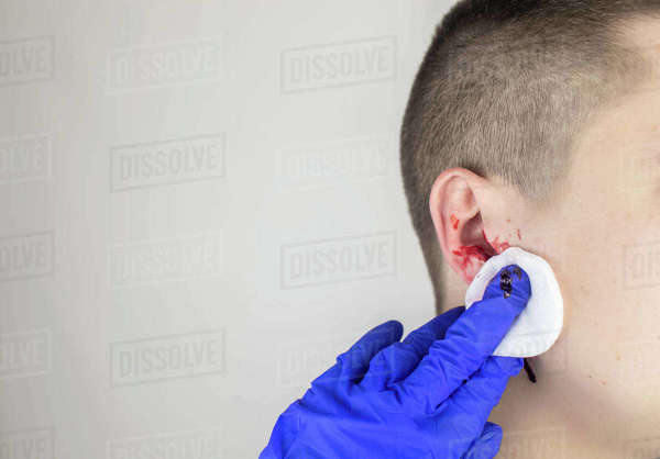 A man whose ear is bleeding. Vascular rupture, damage to the tympanic ...
