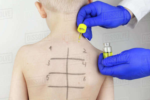 An allergist in the laboratory conducts an allergy prick-test. Skin ...