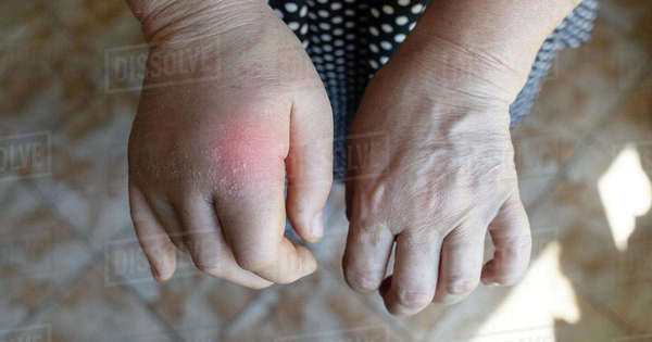 Close-up hand inflammation. Left hand was very swollen in region of the ...