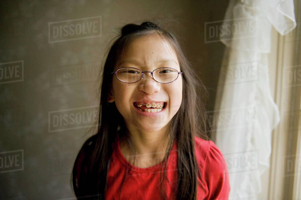 Portrait of a girl with repaired cleft lip and braces smiles big for ...