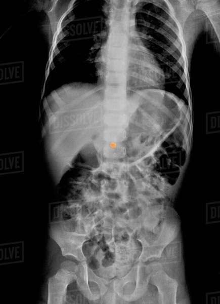 Abdominal X-ray of child, swallowed metal bead - Stock Photo - Dissolve