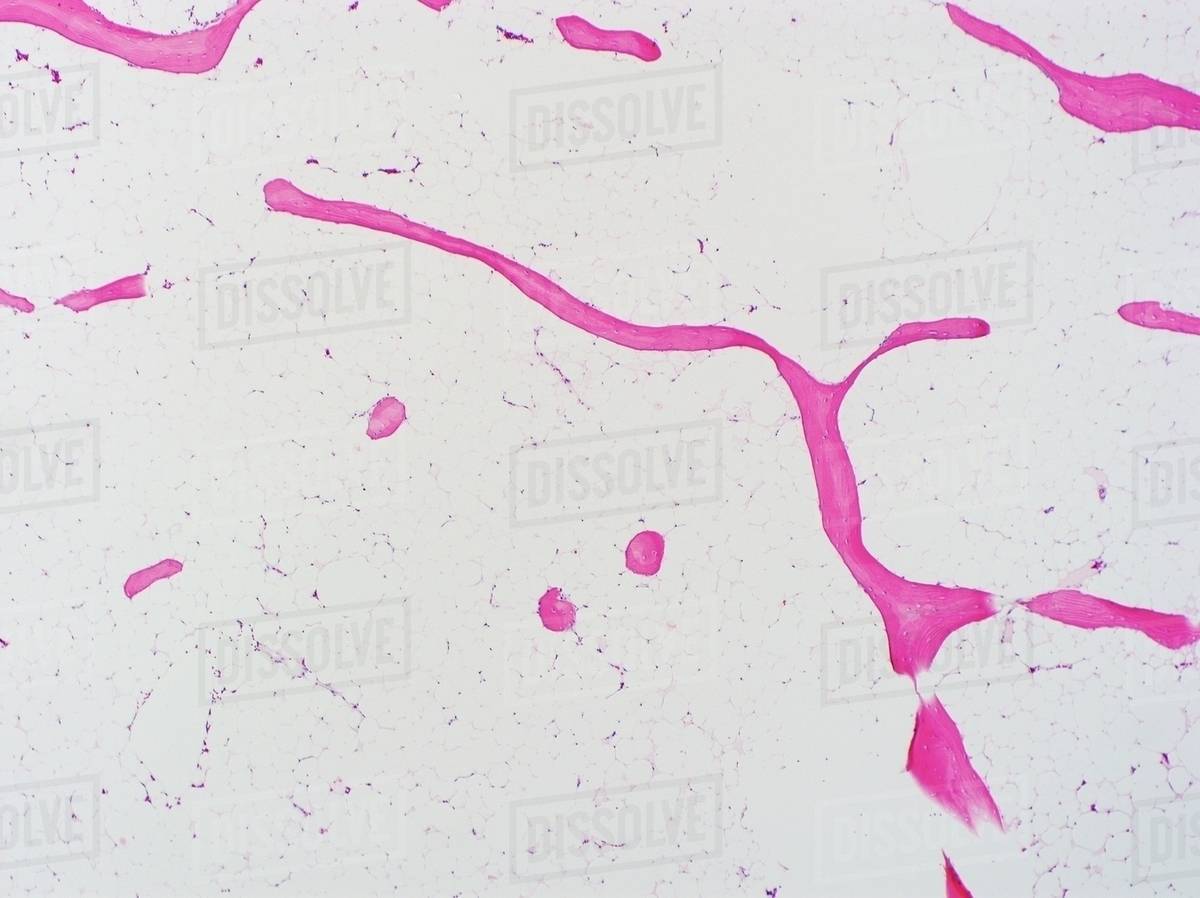 H&E stain, light microscopy, osteoporosis, bone - Royalty-free Stock ...