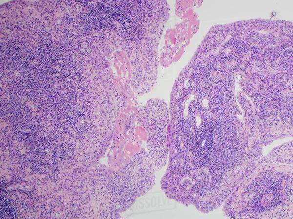 H&E stain, light microscopy, rheumatoid arthritis of joint showing ...