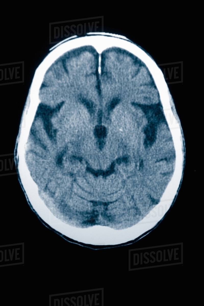 CT scan 84 year old male with Alzheimer's disease. CT shows brain ...