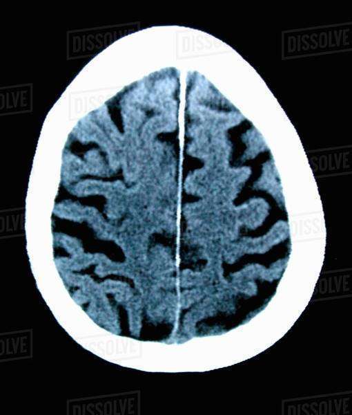 CT scan 84 year old male with Alzheimer's disease. CT shows brain ...
